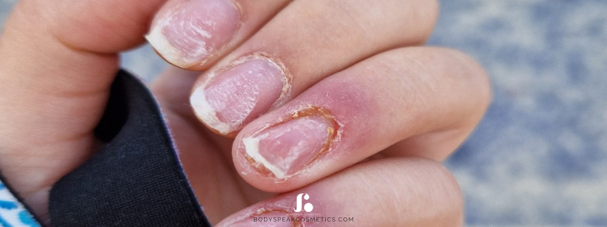 Acrylaten allergieën en kunstnagelproducten – Bodyspeak Cosmetics